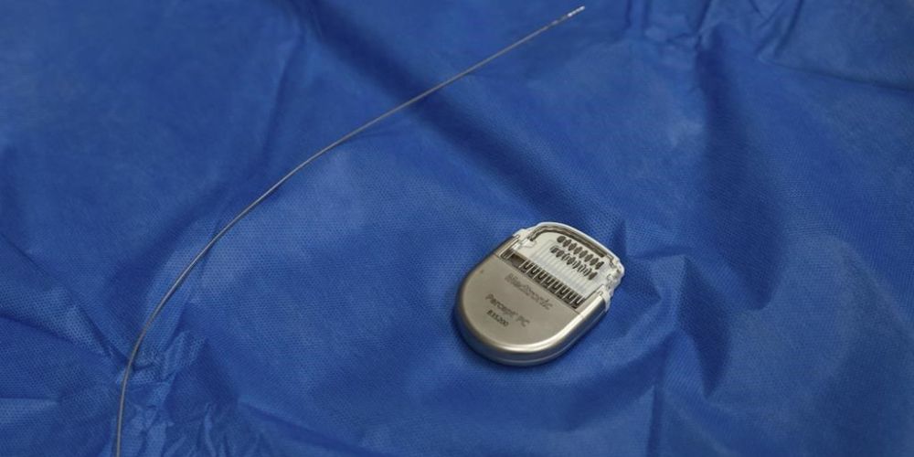 A pacemaker for the brain helped a woman with crippling depression
