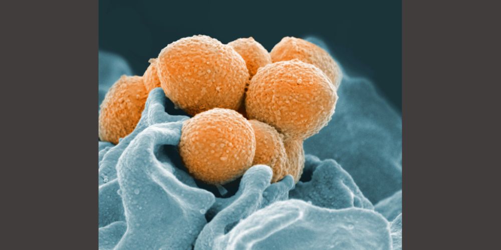 Doctors worry more kids may be getting sick with invasive strep A. Here ...